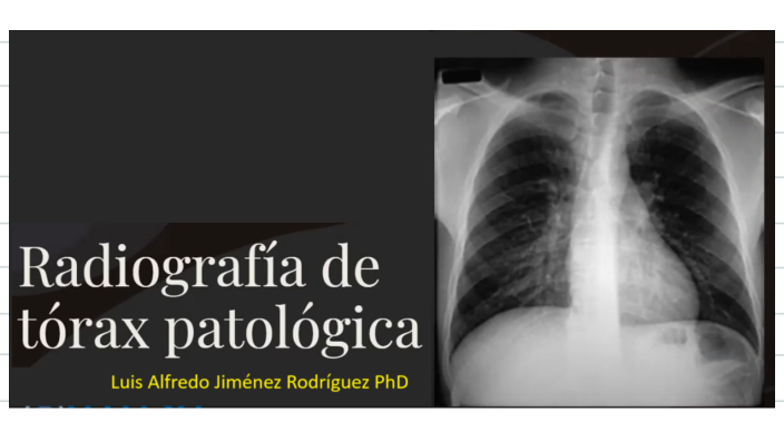TORAX PATOLOGICO by LUIS ALFREDO JIMENEZ RODRIGUEZ on Prezi