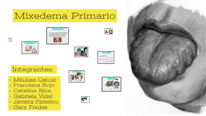 Mixedema Primario by Gary Fredes Rojas on Prezi