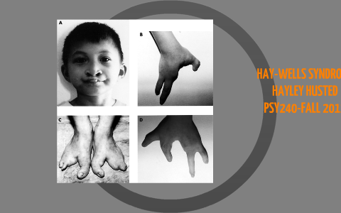 Hay-Wells Syndrome by Hayley Husted on Prezi