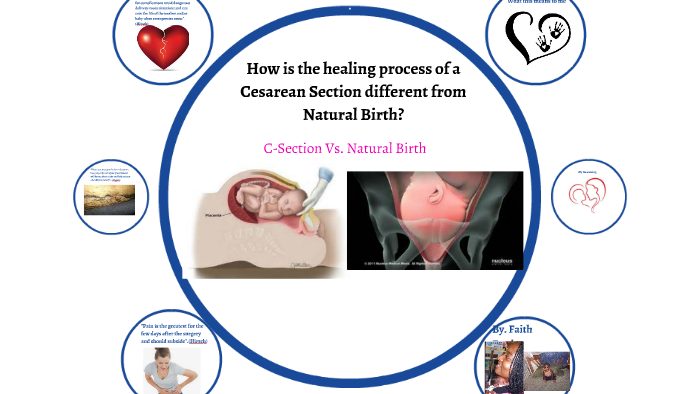 How is a the healing process of a Cesarean Section by Faith Forde on Prezi