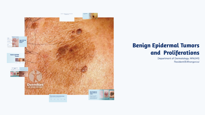 Understanding Benign Epidermal Tumors by Хонгорзул Баярхүү on Prezi