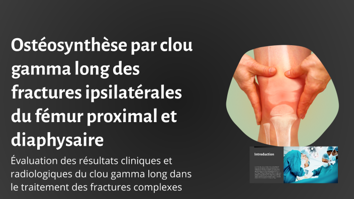 Ostéosynthèse par clou gamma long des fractures ipsilatérales du fémur ...