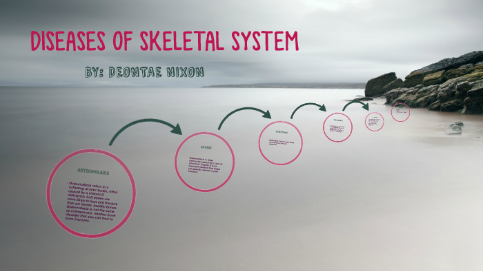 Osteomalacia refers to a softening of your bones, often caus by deontae ...