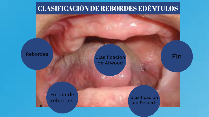 Clasificacion de rebordes edentulos, forma, tipo y clasificaciones de ...