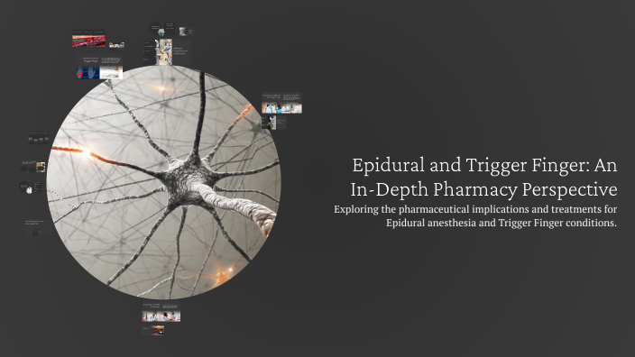 Epidural and Trigger Finger: An In-Depth Pharmacy Perspective by Abi ...