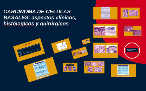 CARCINOMA DE CÉLULAS BASALES: aspectos clínicos, histólogico by Gylari ...