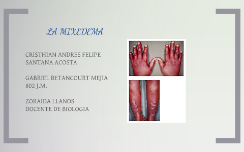LA MIXEDEMA by cristhian andres santana acosta on Prezi