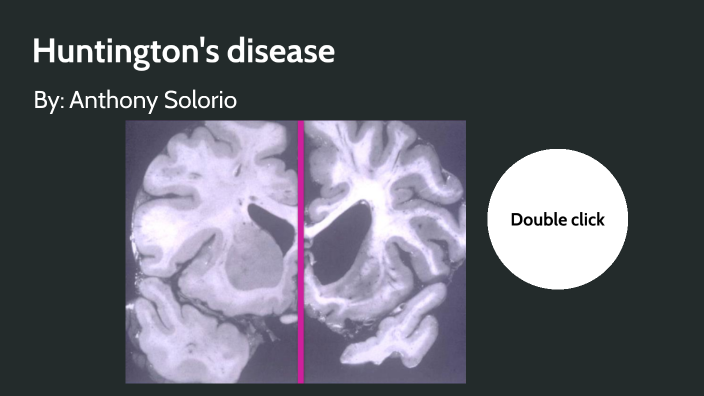 Huntington's disease by Anthony Solorio on Prezi