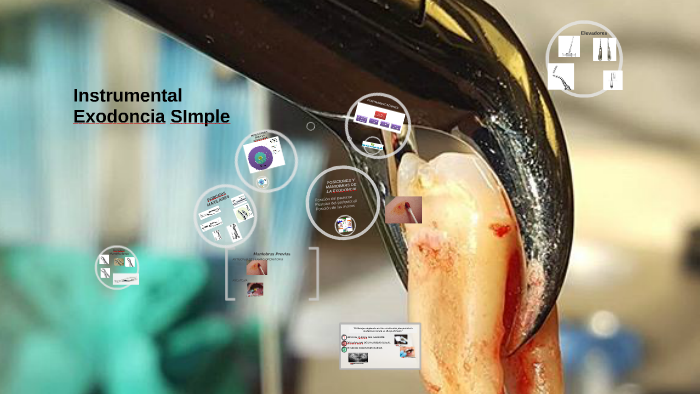 EXODONCIA SIMPLE by ulises valdespino on Prezi
