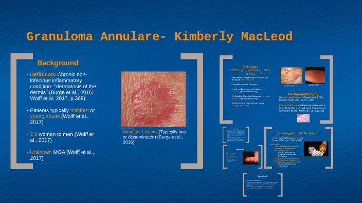 Granuloma Annulare by Kim Macleod on Prezi
