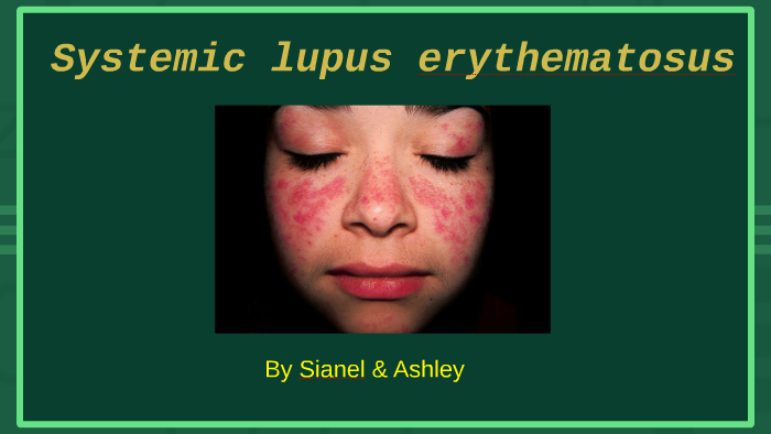 Systemic lupus erythematosus by sianel rivera
