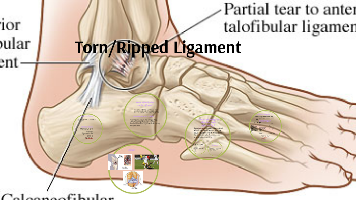 Torn/Ripped LIgament by oscar manson on Prezi