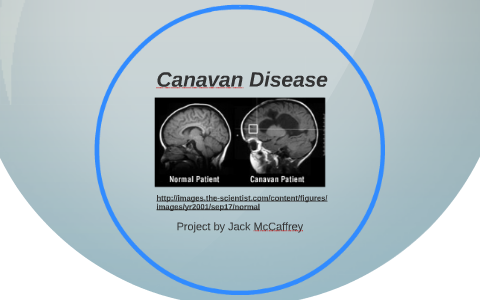Canavan Disease by on Prezi