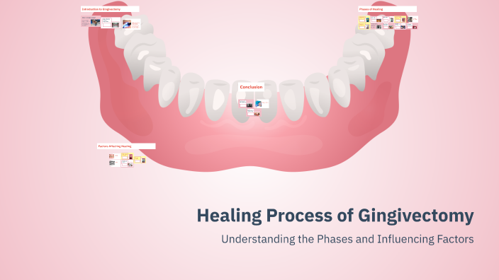Healing Process of Gingivectomy by Chanar Sulaiman on Prezi