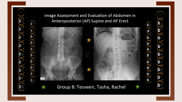 Image Assessment and Evaluation of Abdomen in Anteroposterior (AP ...
