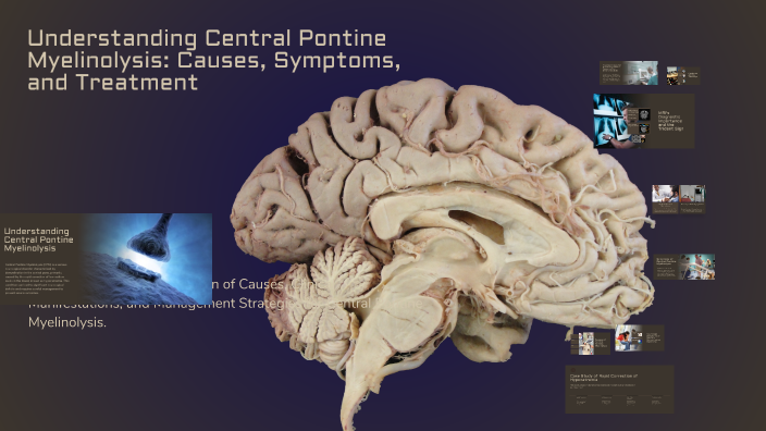 Understanding Central Pontine Myelinolysis: Causes, Symptoms, and ...