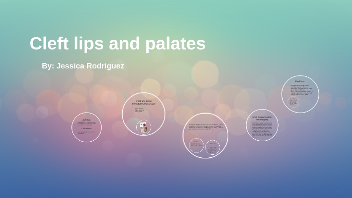 cleft lips by jessica rodriguez on Prezi