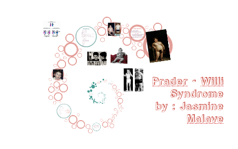 Prader - WIlli Syndrome by Jasmine Malave on Prezi