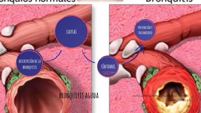 Bronquitis aguda by Alicia Ruiz on Prezi
