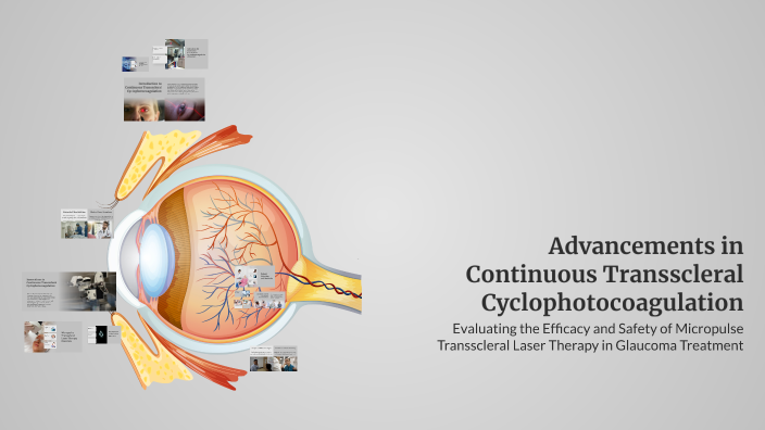 Advancements in Continuous Transscleral Cyclophotocoagulation by Italo ...