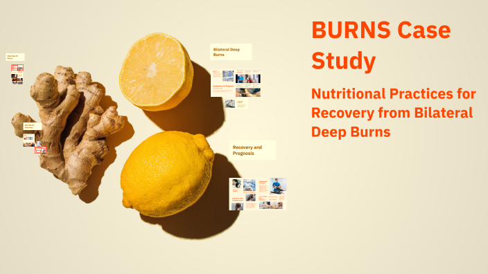 BURNS Case Study by harshini mummana on Prezi