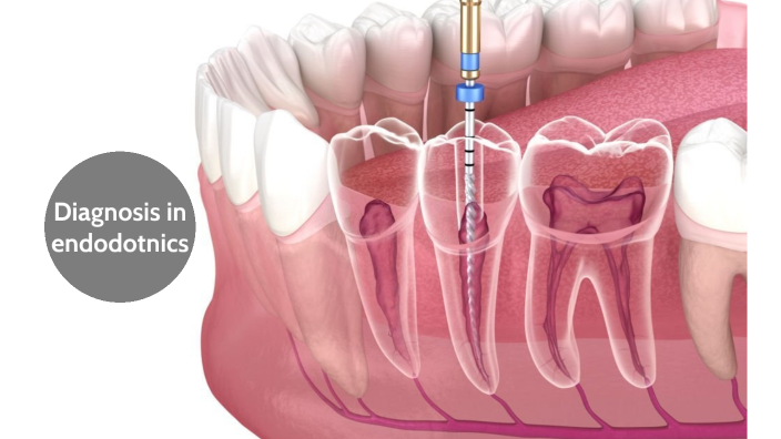 Diagnosis in endodontics by Abdelrahman Alamir on Prezi