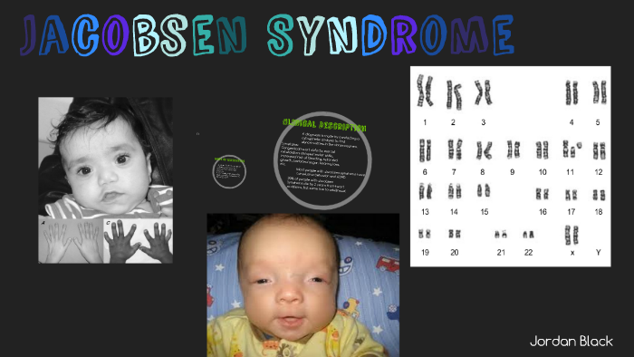 Jacobsen Syndrome by Jordan Black on Prezi