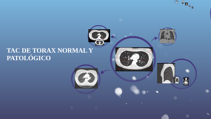 TAC DE TORAX NORMAL Y PATOLÓGICP by Tatiana Intriago on Prezi
