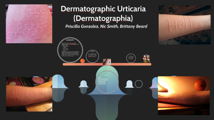 Dermatographic Urticaria by Priscilla Gonzalez on Prezi
