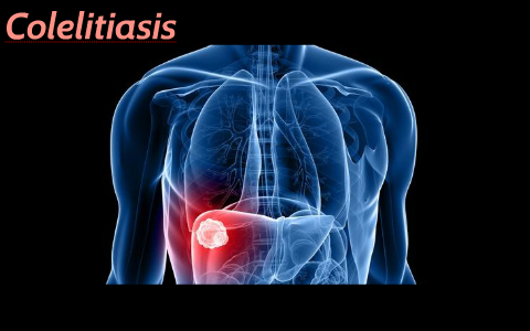 Colelitiasis by aylinn alvarez on Prezi