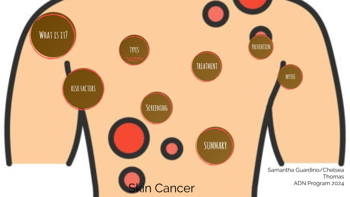 Community Research Project - Skin Cancer by Sam Guardino on Prezi