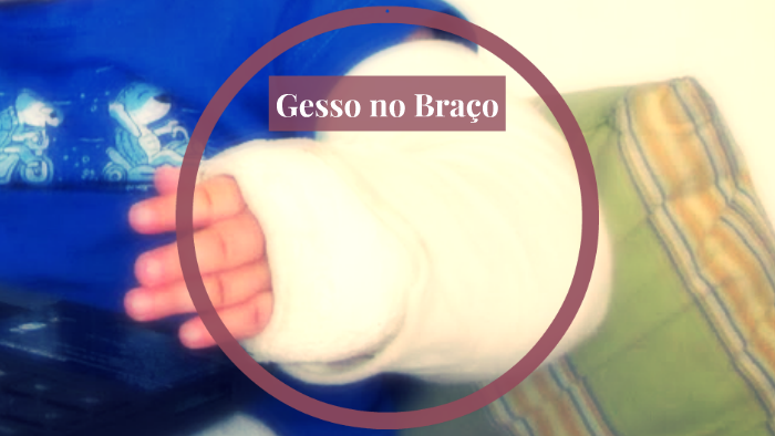 Gesso No Braço By Denilson Danieli On Prezi