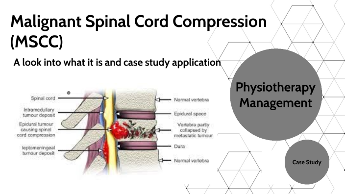 Metastatic Spinal Cord Compression by Ellie Burden on Prezi