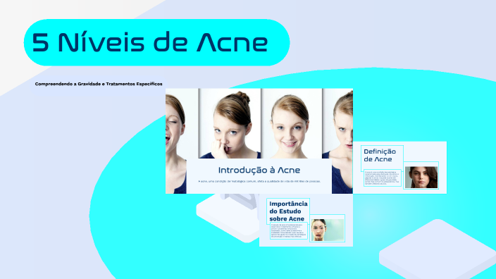 5 Níveis de Acne by Igor Carvalho on Prezi