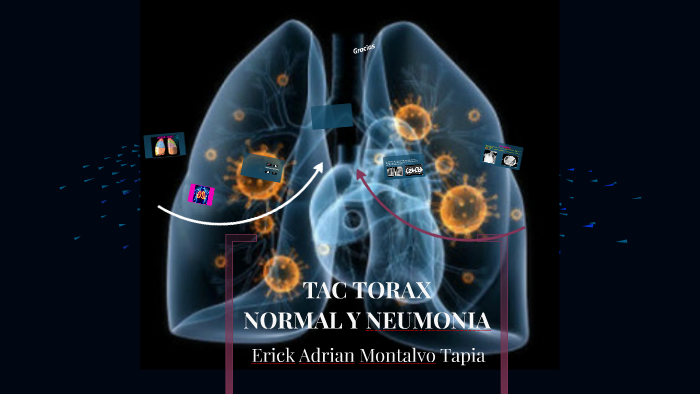 TAC TORAX NORMAL Y NEUMONIA by Ericka Alexandra Coello Lopez on Prezi