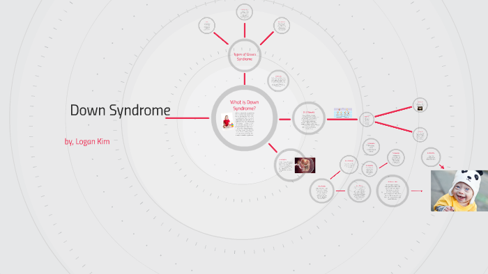 Down Syndrome by Logan Kim on Prezi