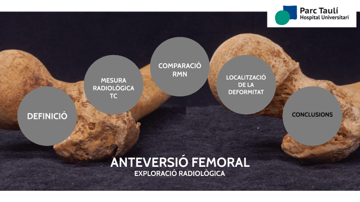 ANTEVERSIO FEMORAL by on Prezi