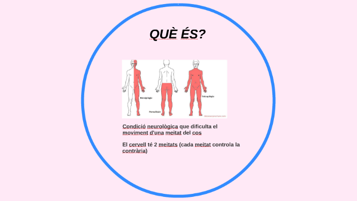 HEMIPARÈSIA by Lucía Muñoz Ramos on Prezi