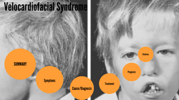 Velocardiofacial Syndrome by Tegan Davis _ Student - WakefieldHS on Prezi