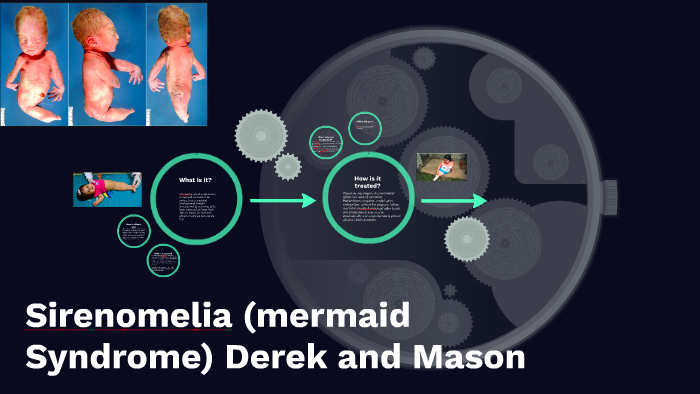 Sirenomelia (mermaid Syndrome) by on Prezi