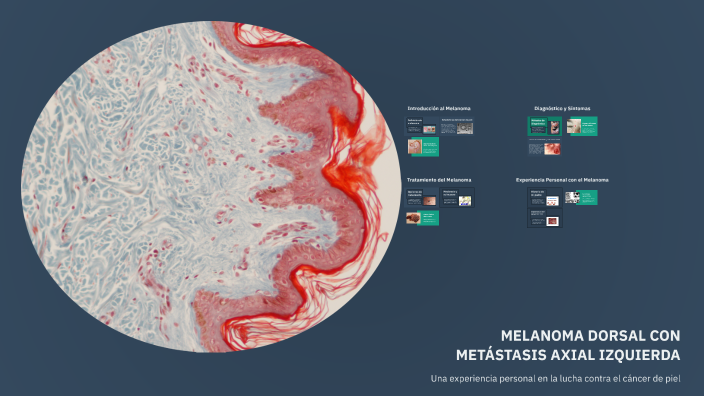 MELANOMA DORSAL CON METÁSTASIS AXIAL IZQUIERDA by Andrea Daniela ...