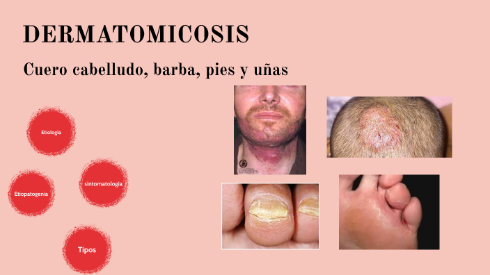 DERMATOMICOSIS by Fabi Toledo on Prezi