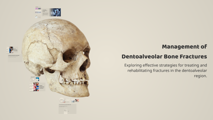Management of Dentoalveolar Bone Fractures by سطام المطيري on Prezi