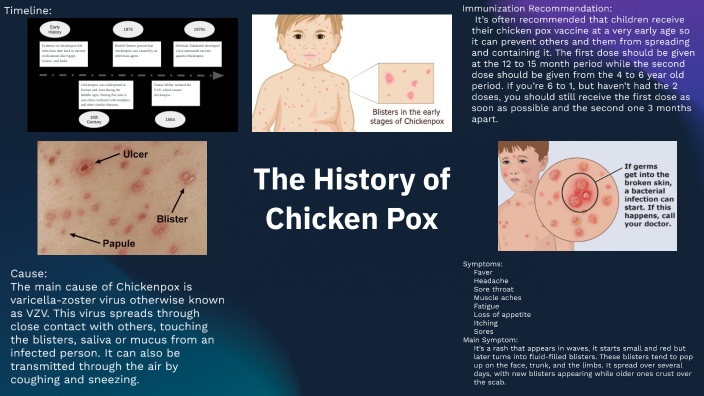The History of Chicken Pox by Connor Morgan (Student) on Prezi