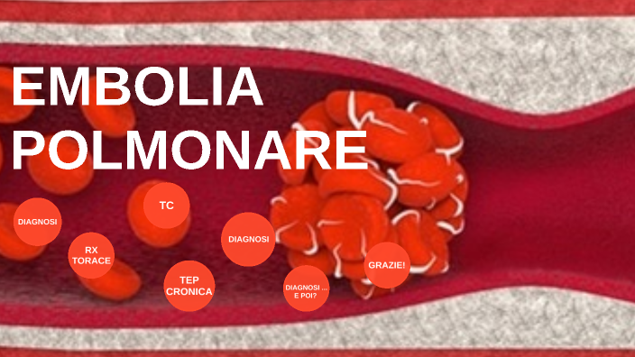 embolia polmonare by Chiara Tavella on Prezi