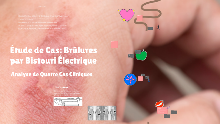 Brûlure par Plaque de Bistouri Électrique by Allan Baldini on Prezi