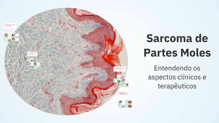 Sarcoma de Partes Moles by Alice Cabral on Prezi