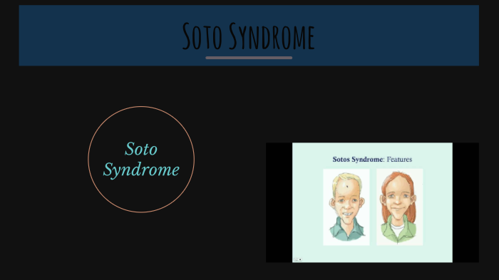 Soto Syndrome by Patricia Lopez on Prezi