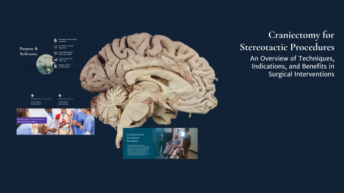 Craniectomy for Stereotactic Procedures by Kristan Moore on Prezi