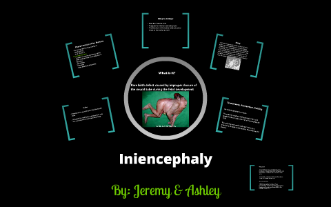 Iniencephaly by Ashley Van Sickle on Prezi